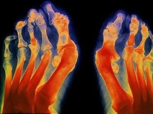 ΟΥΡΙΚΗ ΑΡΘΡΙΤΙΔΑ ΚΑΙ 3 ΦΥΣΙΚΕΣ ΘΕΡΑΠΕΙΕΣ | Bioathens